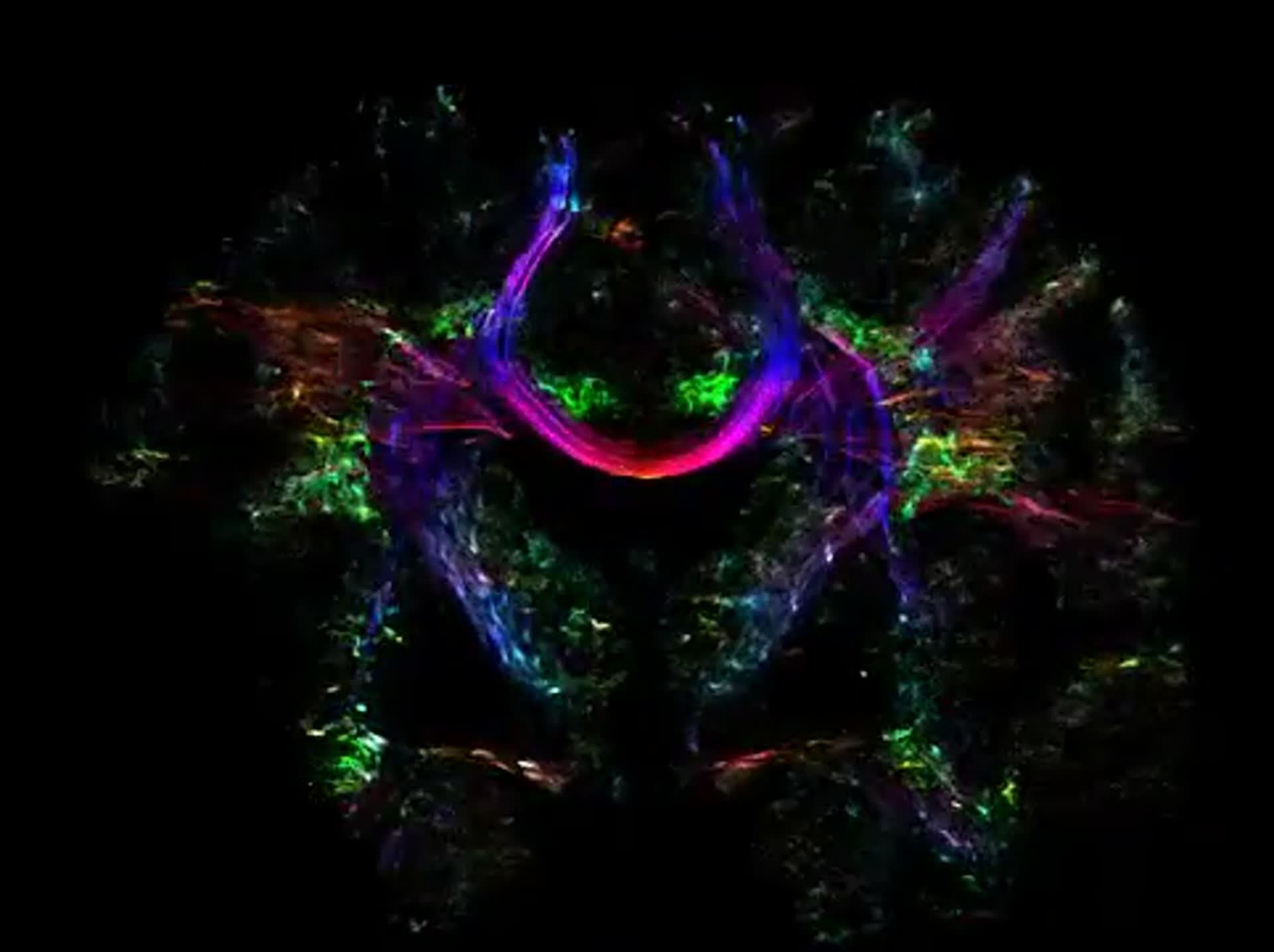 Diffusion MRI Brain Fibre Tractography - DocCheck