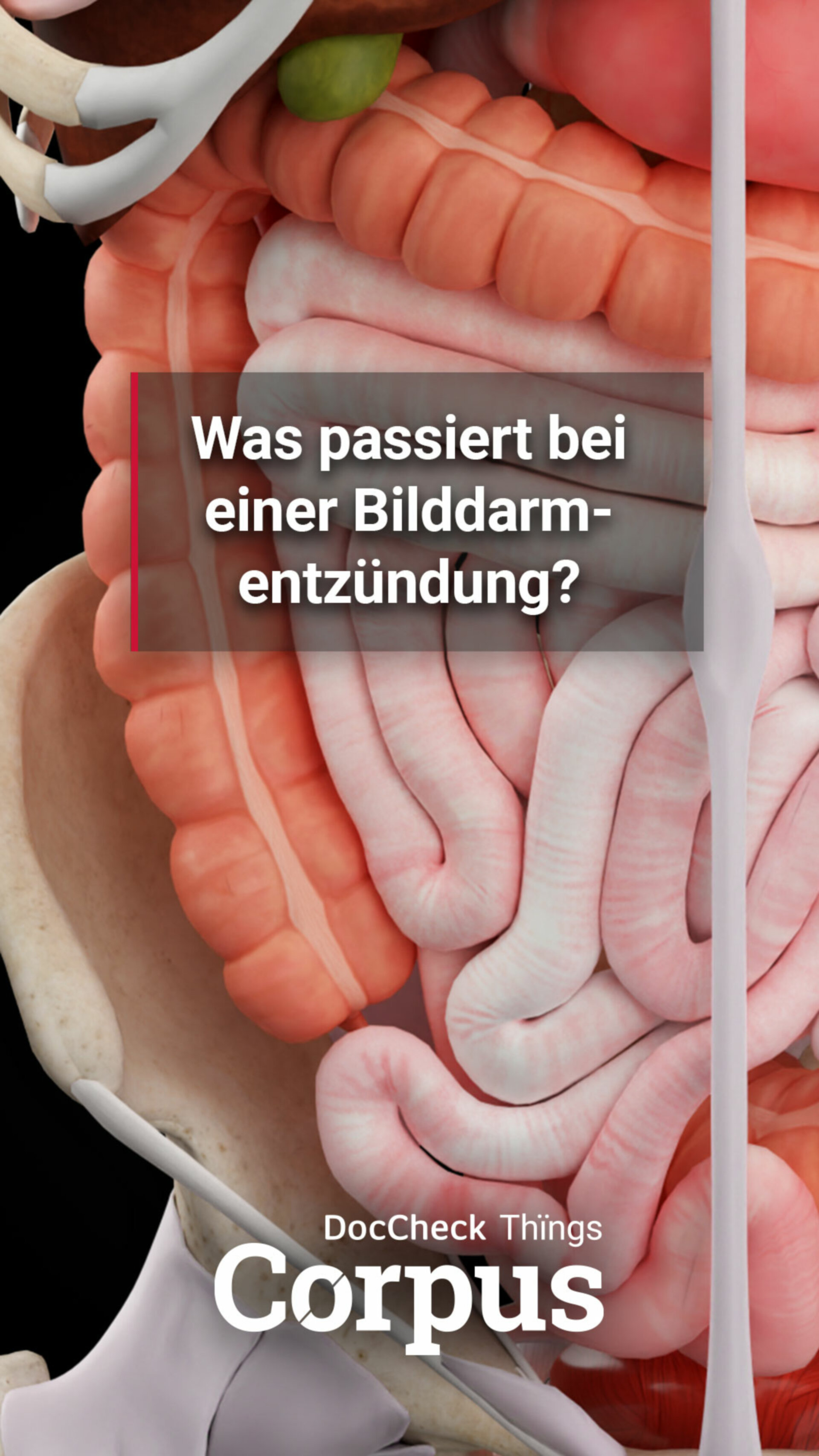 Anatomie zum Anfassen: Appendizitis - DocCheck