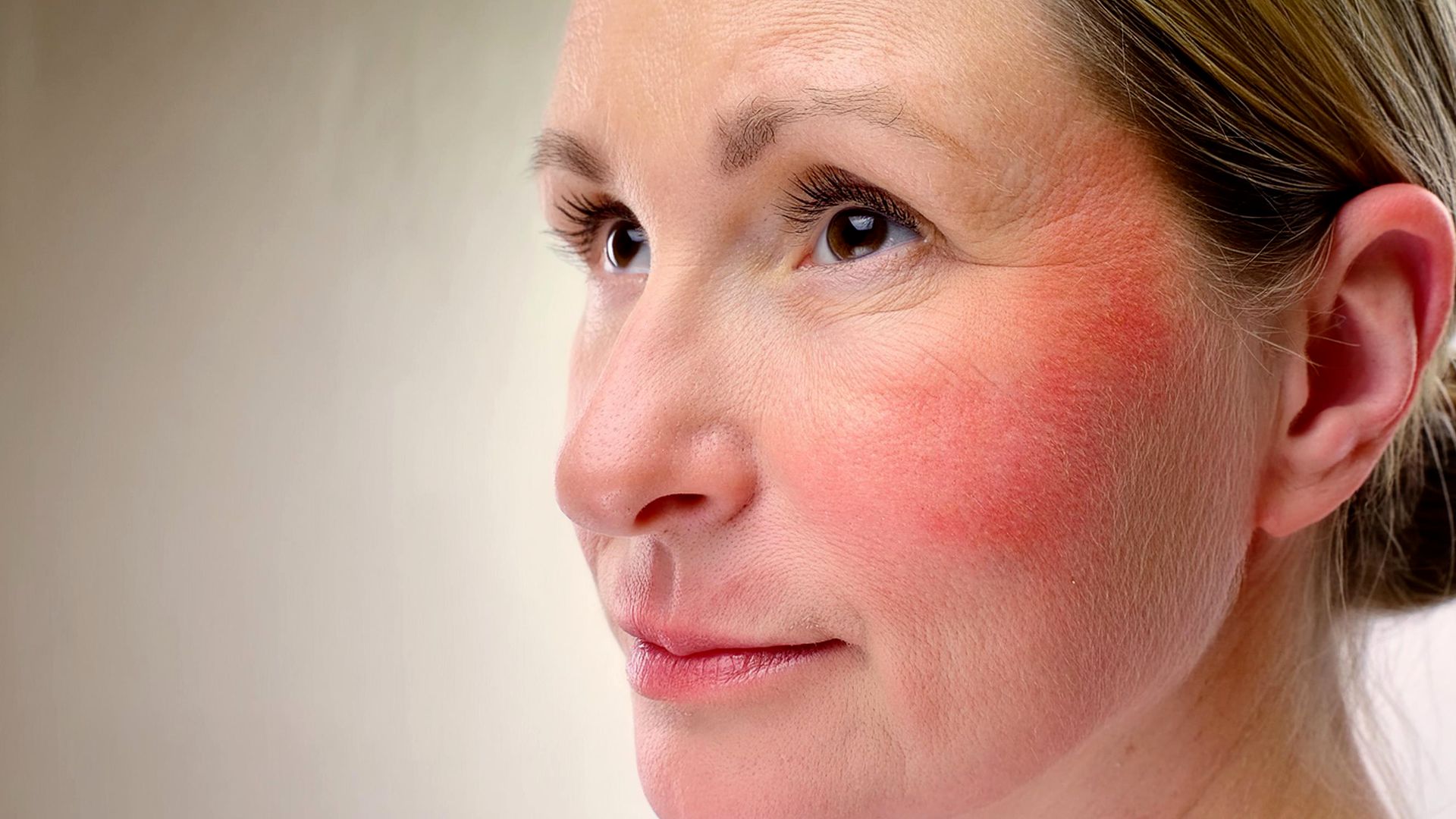 Erythrophobie: Rot vor Angst - DocCheck