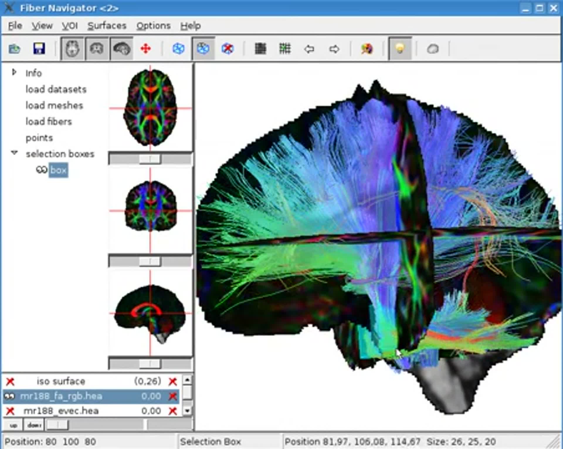 Diffusion MRI Brain Fibre Tractography - White Matter Imaging - DocCheck