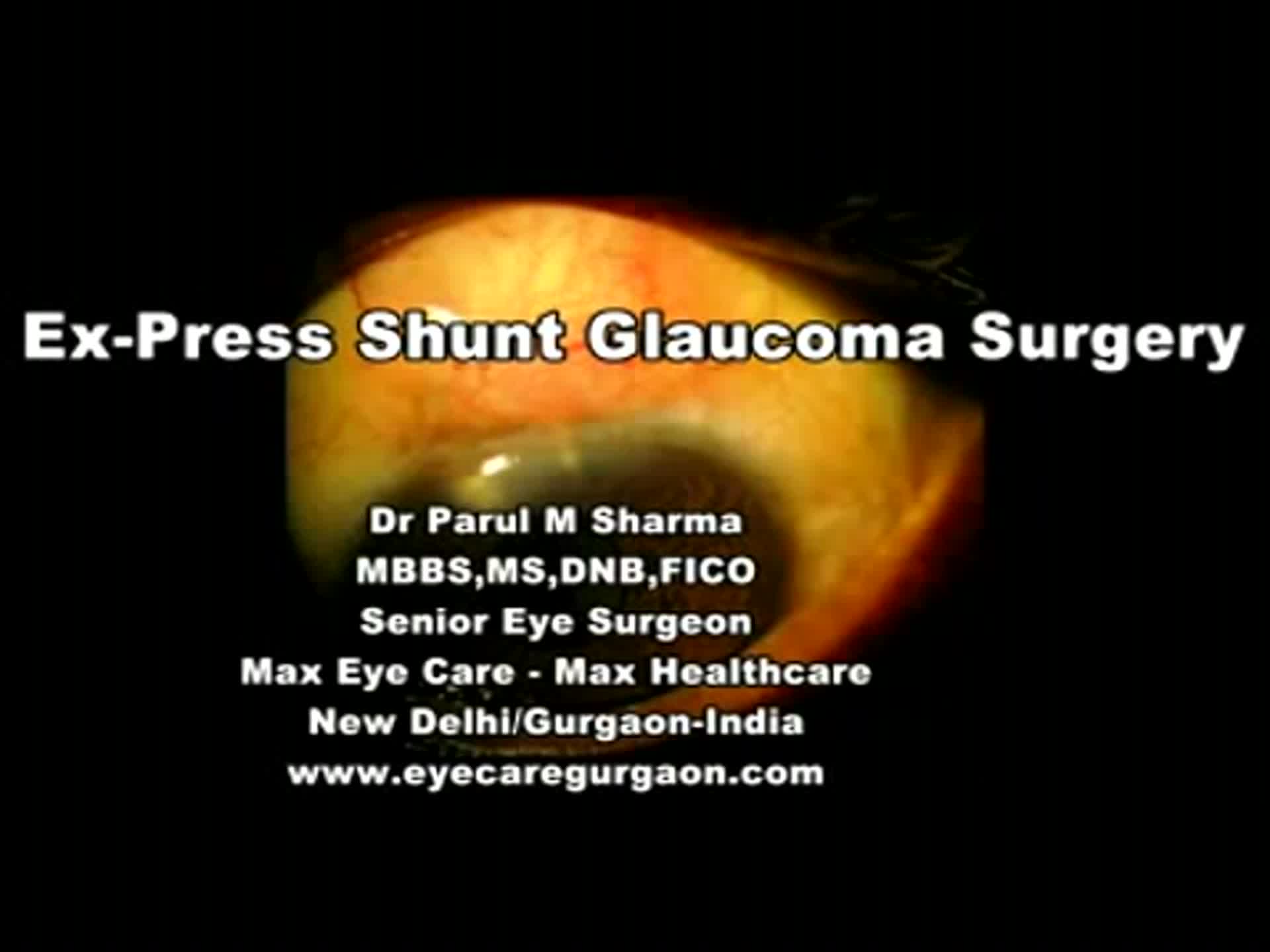 Express Shunt Glaucoma Information Glaucoma — Eye Surgery Associates