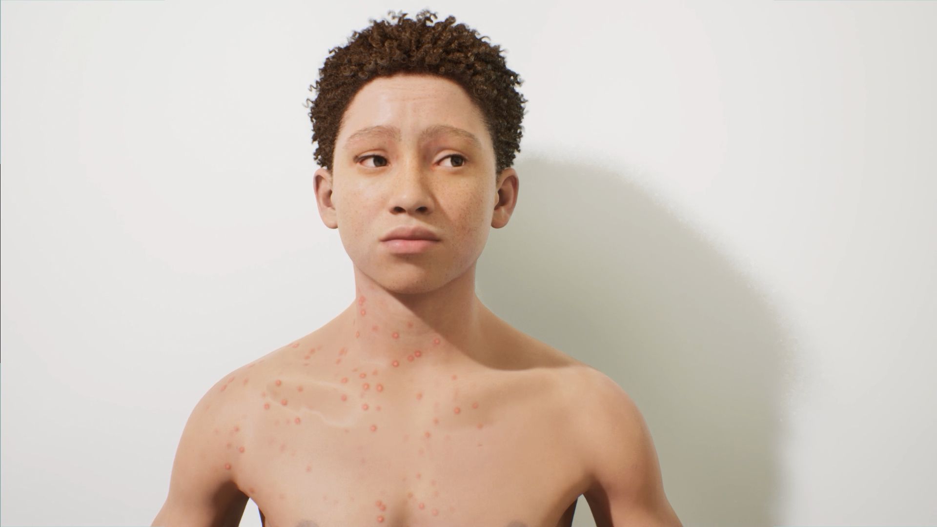 Windpocken: Symptomverlauf - DocCheck