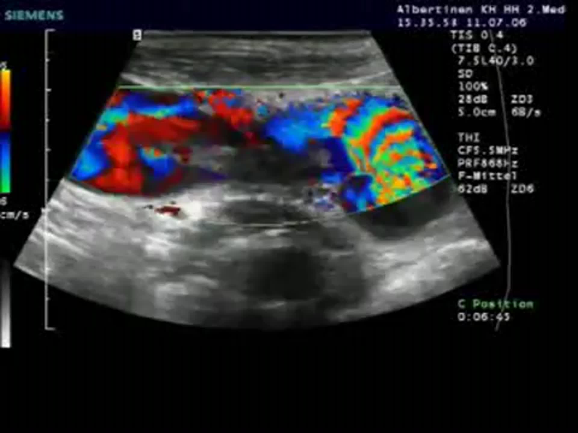 Vena jugularis - Thrombose - DocCheck