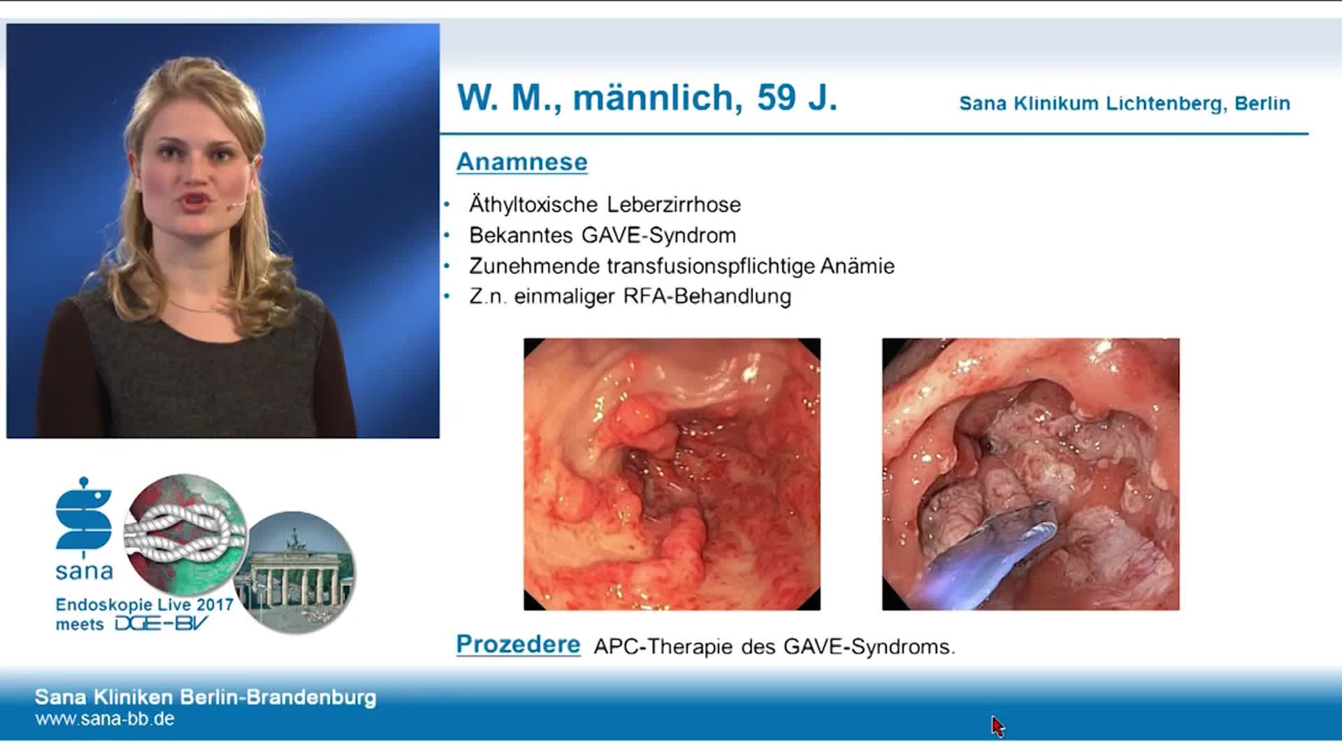 GAVE – Syndrom - Therapie mit Hybrid-APC - DocCheck