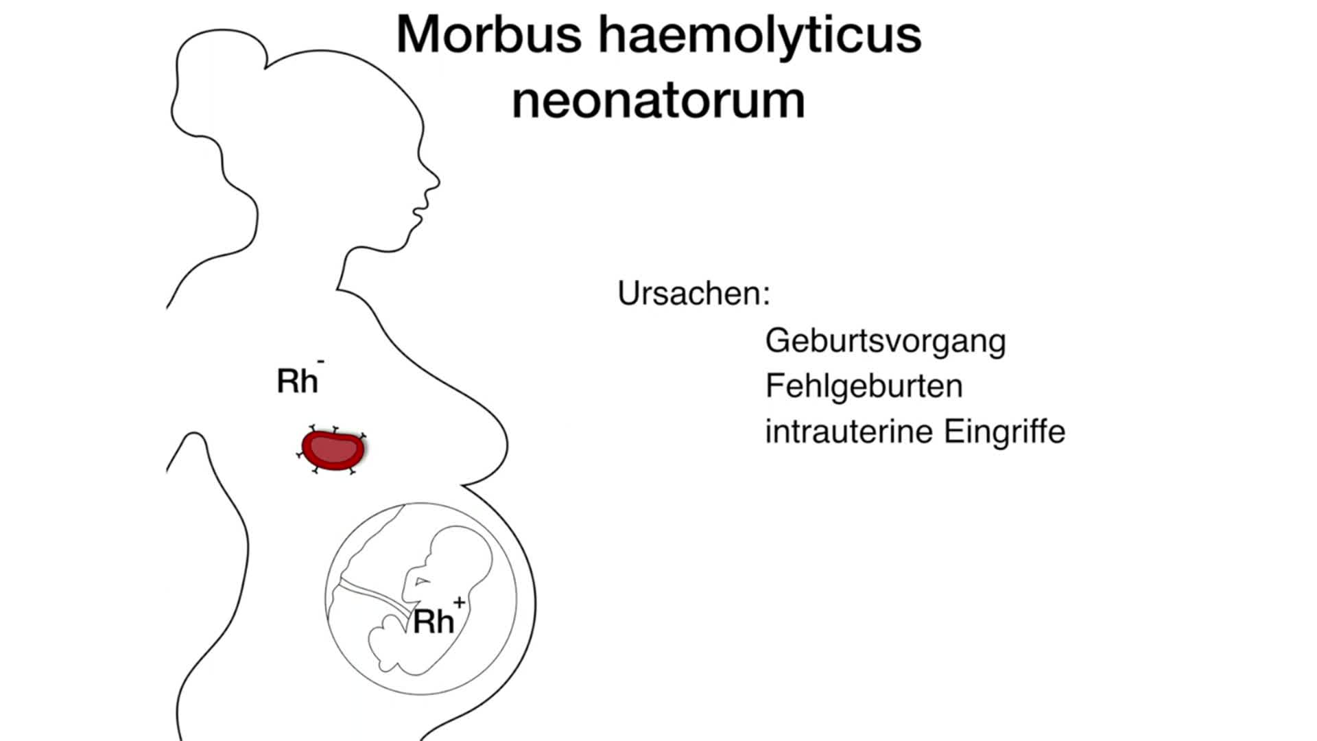 Morbus haemolyticus neonatorum - Pathophysiologie - DocCheck