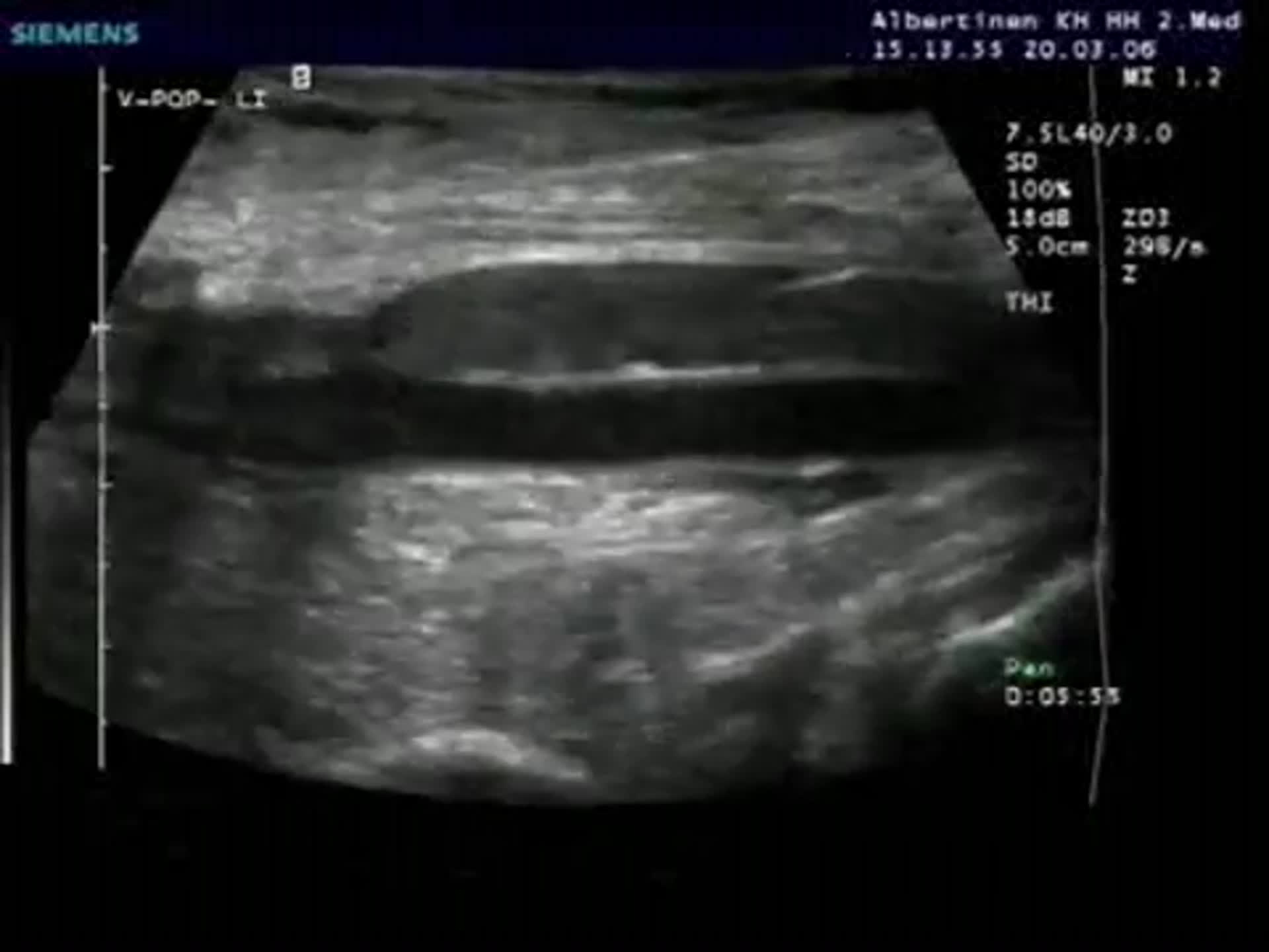 Erythrozyten-Aggregation (1) - DocCheck