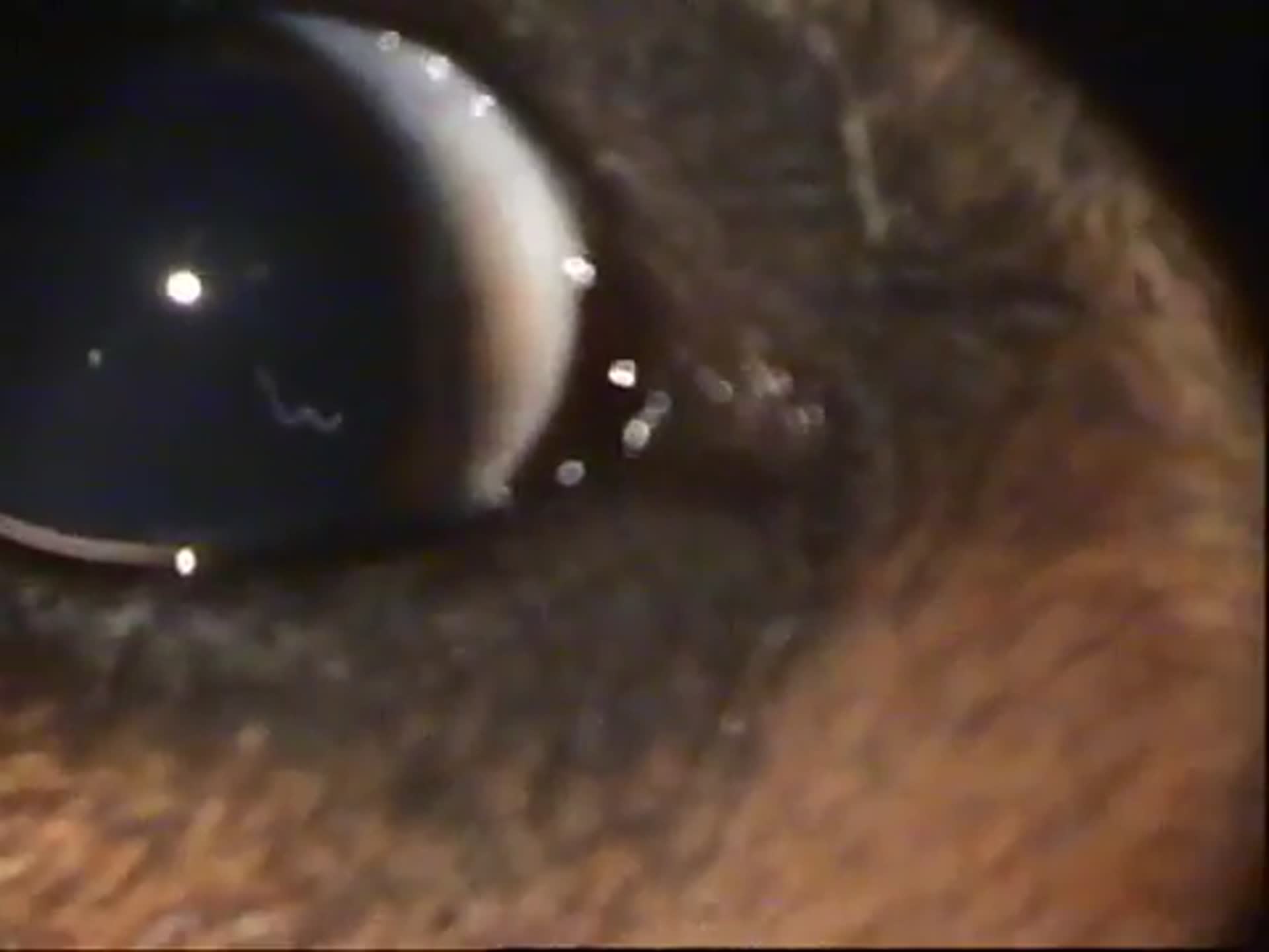 Arteria hyaloidea persistens - DocCheck