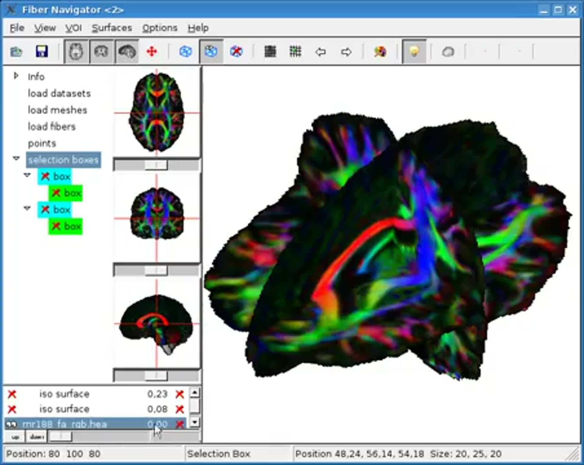 Diffusion MRI Brain Fibre Tractography - Fibernavigator - DocCheck