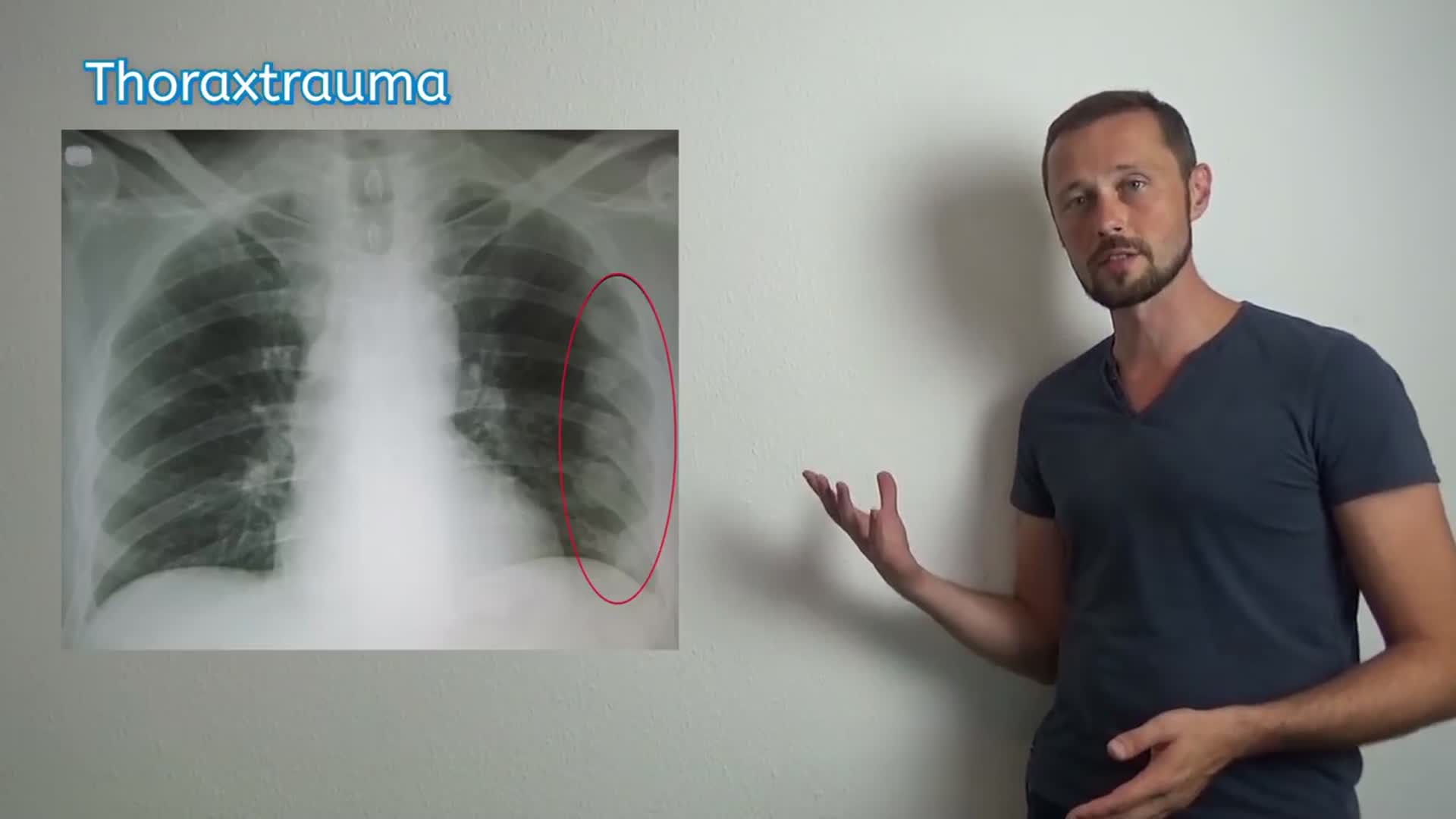 Das Thoraxtrauma (Beatmungsspezifisch) - DocCheck