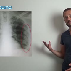 Lungenkontusion - DocCheck Flexikon