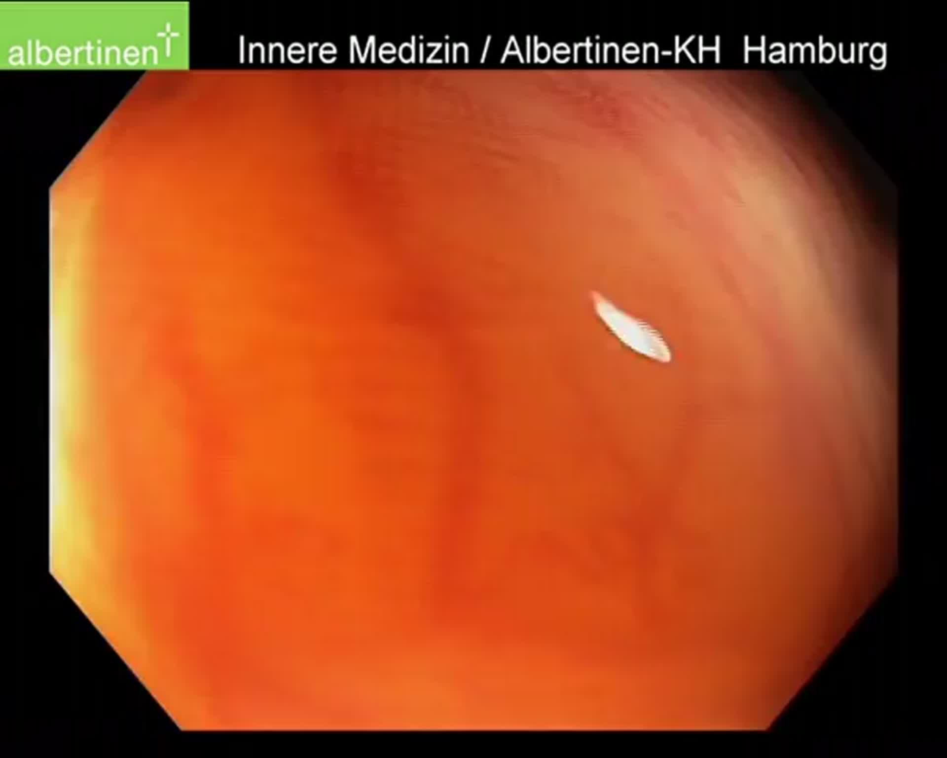 Ischämische Colitis Sigma - DocCheck